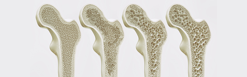 Fosamax for Osteoporosis - Canada Pharmacy