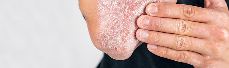 Most Popular Psoriasis Medications | Canada Pharmacy