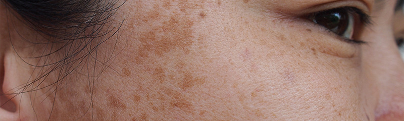 How to Protect Your Skin & Prevent Pigment Disorders