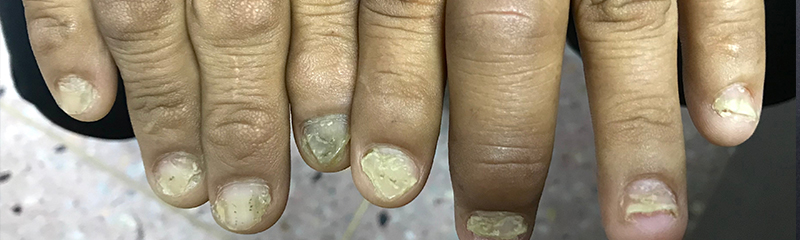 What Are The 5 Types of Psoriatic Arthritis?